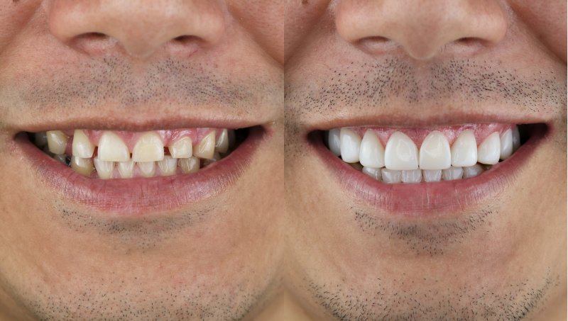 What To Know About Small Teeth | Seahurst Park Dentistry